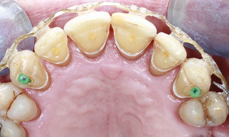 Les contentions orthodontiques | Dr Patrick FOURNIER