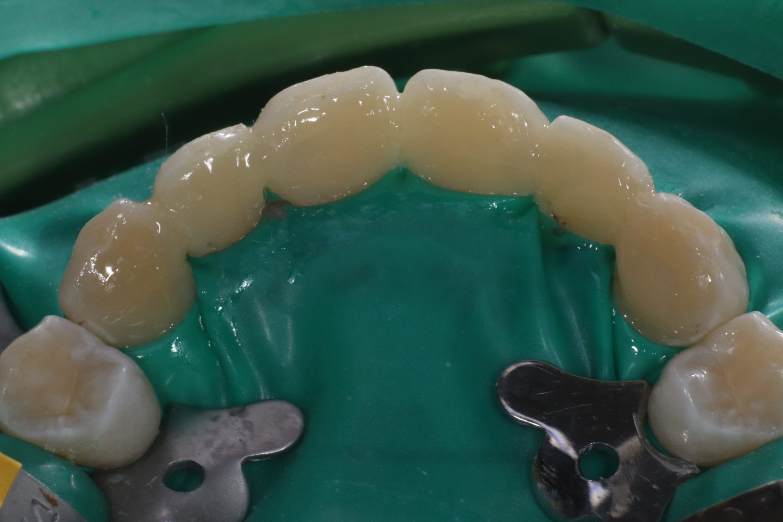 Les contentions orthodontiques | Dr Patrick FOURNIER