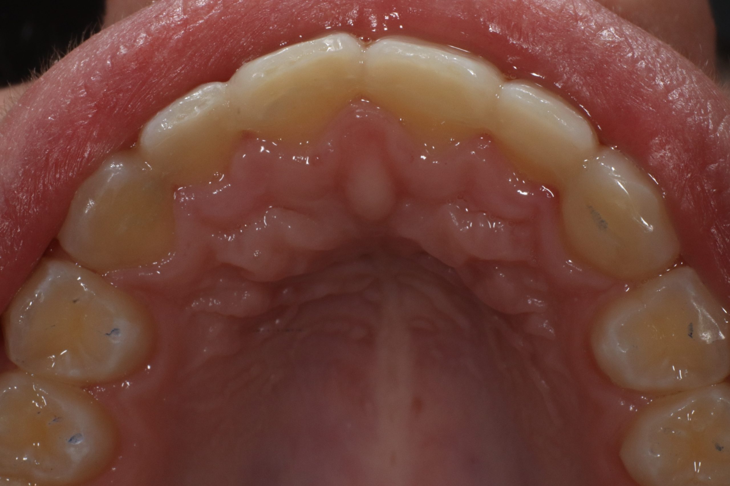 Les contentions orthodontiques | Dr Patrick FOURNIER